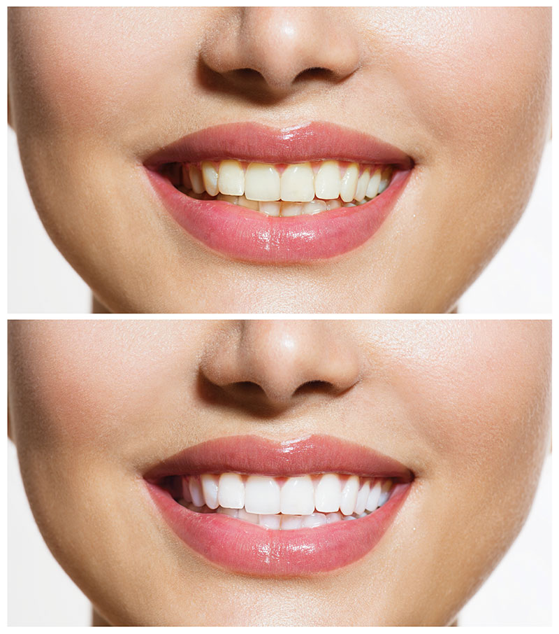 Dentist in Phoenixville, PA | Teeth Whitening